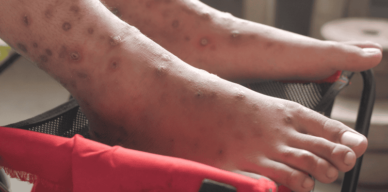 Cara Rawat Kudis Buta: Bahan Semula Jadi Berikut Mungkin Boleh Bantu!