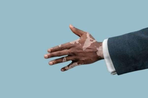 Tompok Hitam Di Badan, Apakah Penyebab Di Sebaliknya? - Hello Doktor