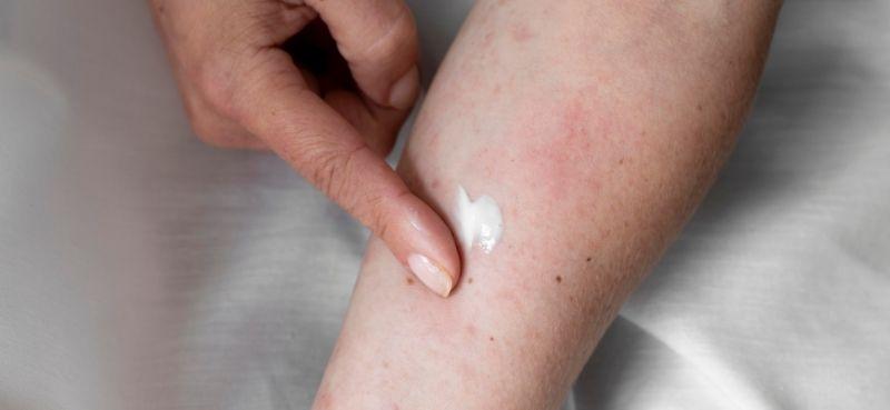 Jenis Jenis Penyakit Kulit, 7 Jangkitan Kulit Yang Anda Perlu Tahu!