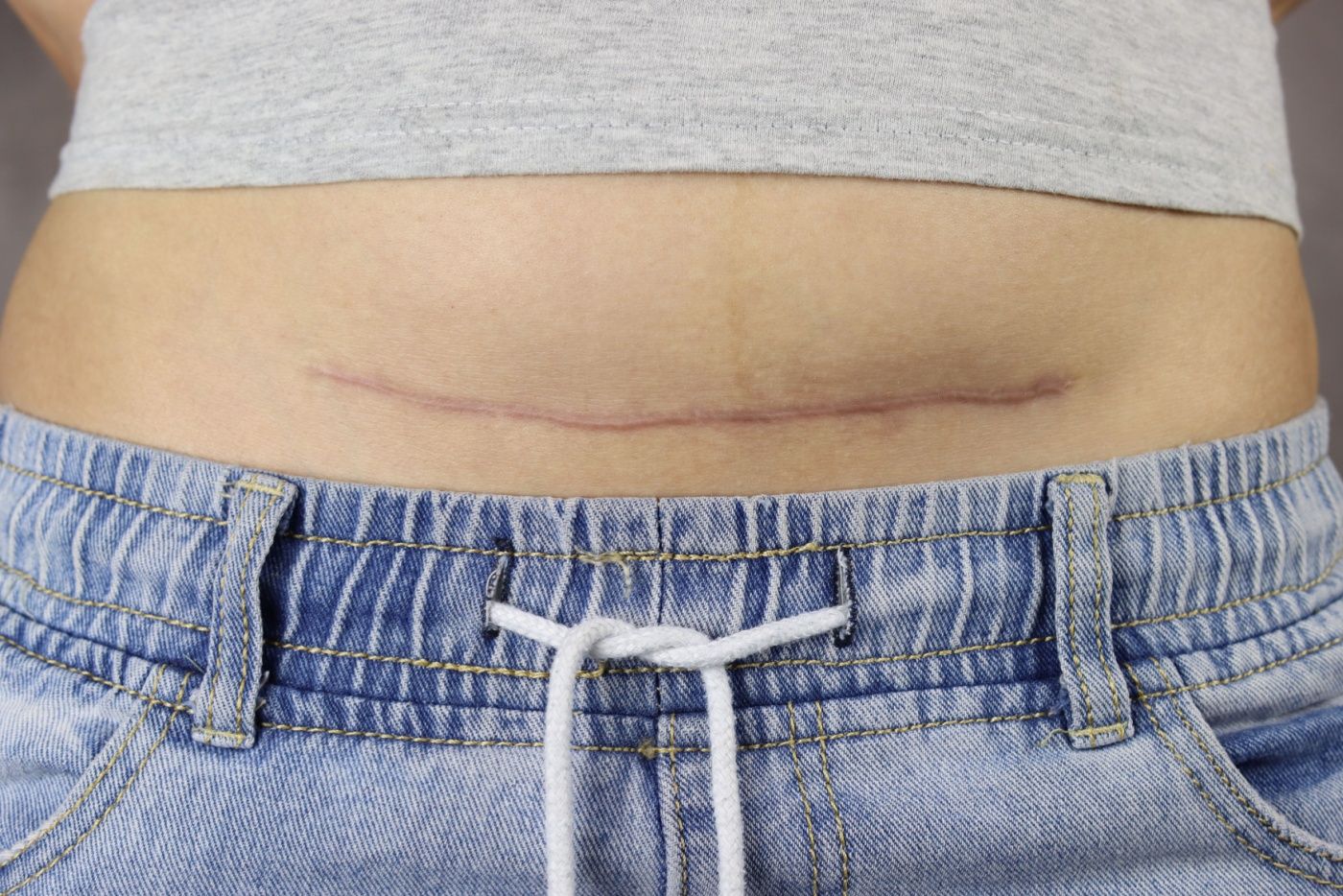 Luka Czer Terbuka Disebabkan 4 Punca Ini, Hati-Hati Ya Ibu Baru Bersalin!