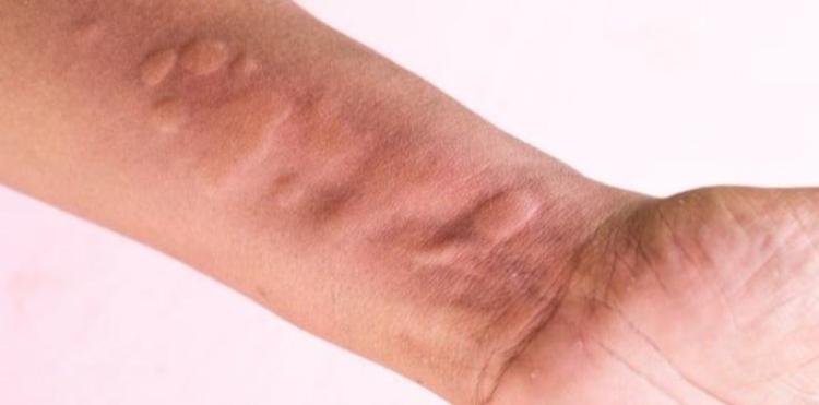 Kelopak Garam Tumbuh Di Serata Badan? Ini Punca & Cara Merawatnya!