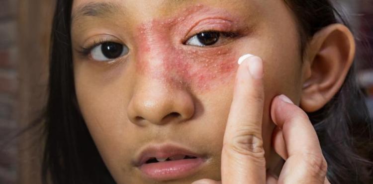 Kurap Kering: Ini Cara Efektif Untuk Hilangkan Kegatalan Dan Elak Parut!