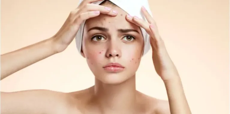 Punca Jerawat Di Dahi: Kenal Pasti 7 Faktor Ini, Bukan Sebab Bercinta!