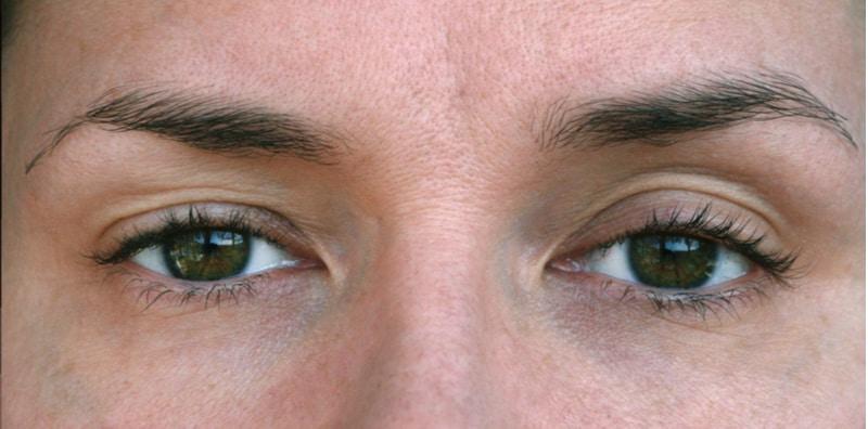 Mata Sepet Secara Tiba-tiba? Semak Punca & Rawatannya