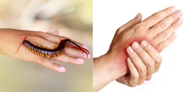 Kesan Gigitan Lipan, Apa Yang Perlu Anda Buat Jika Ia Terjadi Di Rumah?