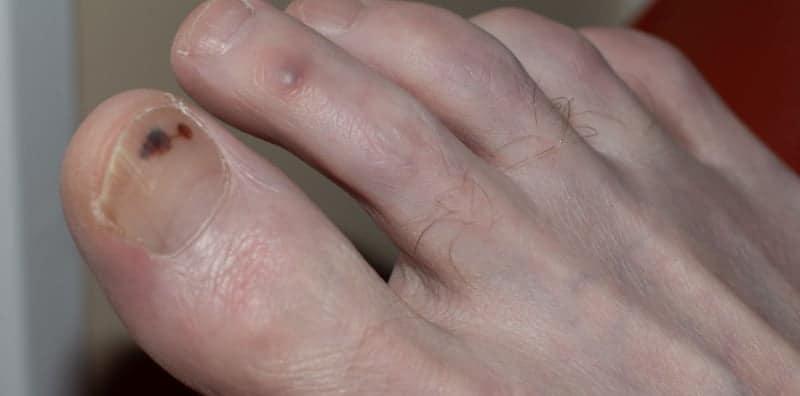 Kuku Hitam Tanda Penyakit Apa? Mungkin Banyak, Kanser Salah Satu!