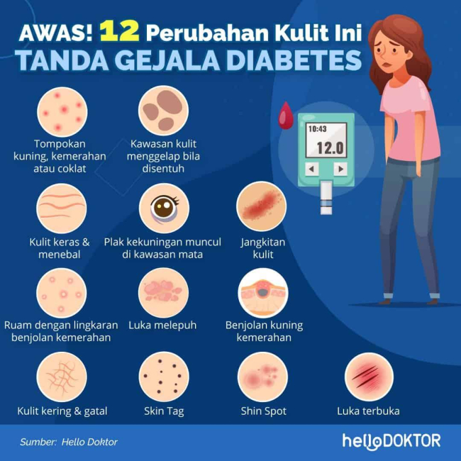 Apakah Itu Diabetes Glikosuria Buah Pinggang? Ini Tanda Awal Yang Rare