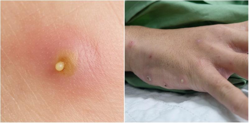 Jenis Gatal Kulit Yang Boleh Berjangkit? Jaga-jaga Dengan 6 Penyakit Ini