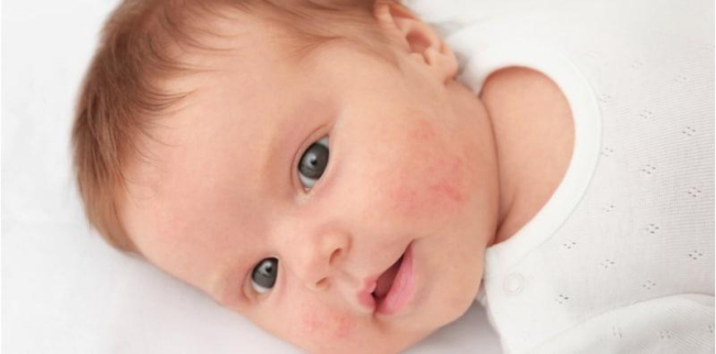 Bedak Ruam Untuk Bayi? Ibu, Rawat Baby Dengan 11 Petua Ini Di Rumah