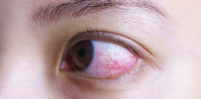 Cacing Pipih Boleh Merebak Ke Mata? Ramai Tak Tahu Perkara Ini