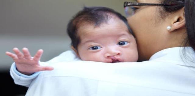 Sumbing Lelangit: Fahami Punca Dan Komplikasinya Pada Si Kecil