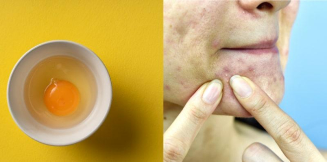 Cara Hilangkan Whitehead, Teknik Tradisional & Moden Ini Boleh Bantu!