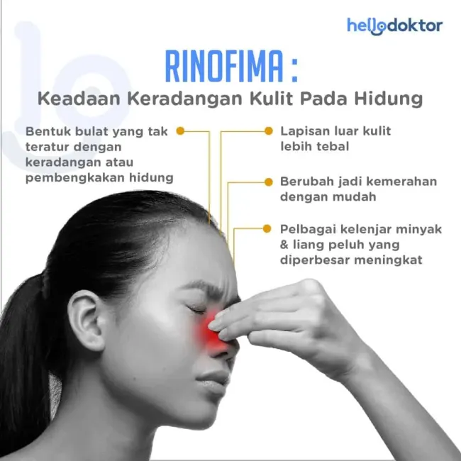 Hidung Tersumbat Sering Mengganggu Anda? Apakah Puncanya?
