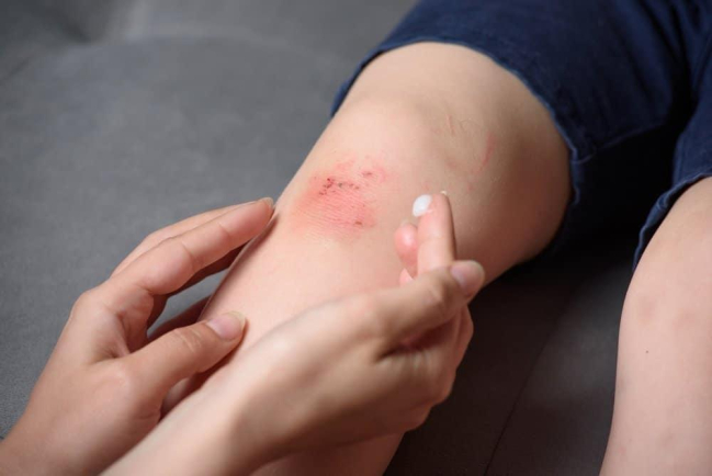 Cara Tradisional Merawat Luka Kencing Manis: Cuba 5 Bahan Ini!