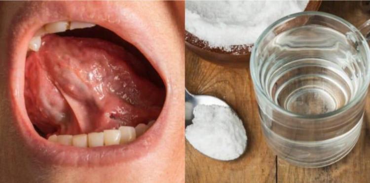 Ubat Ulser Lidah, Kalau Tak Berjaya Cara Moden, Ayuh Cuba 6 Petua Ini!