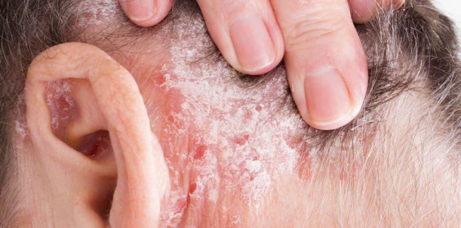 Ubat Psoriasis Paling Berkesan Untuk Berikan Kelegaan Pantas, Ini Dia!