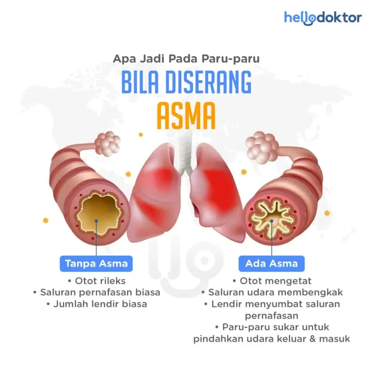 Penyakit Asthma Jenis Teruk Mengakibatkan Sesak Nafas Berlarutan?