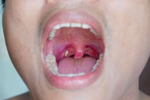 Pantang Larang Tonsil Semasa Sedang Sakit & Selepas Bedah, Sila Ikut!