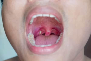 Tonsil Bengkak - Apa Punca, Gejala & Kesan Kondisi Pada Tekak Ini?