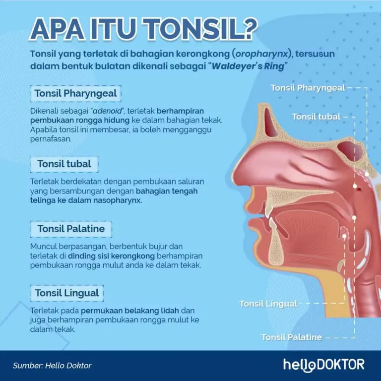 Tonsil Bengkak - Apa Punca, Gejala & Kesan Kondisi Pada Tekak Ini?