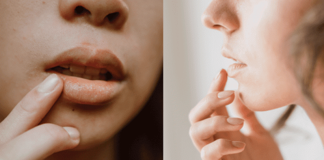 Bibir Atas Bergerak, Bukan Tanda Duit Nak Masuk! Ia Mungkin Penyakit!