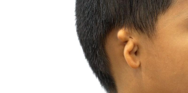 Cuping Telinga Melekap Atau Tidak Normal? Ia Mungkin Masalah Mikrotia