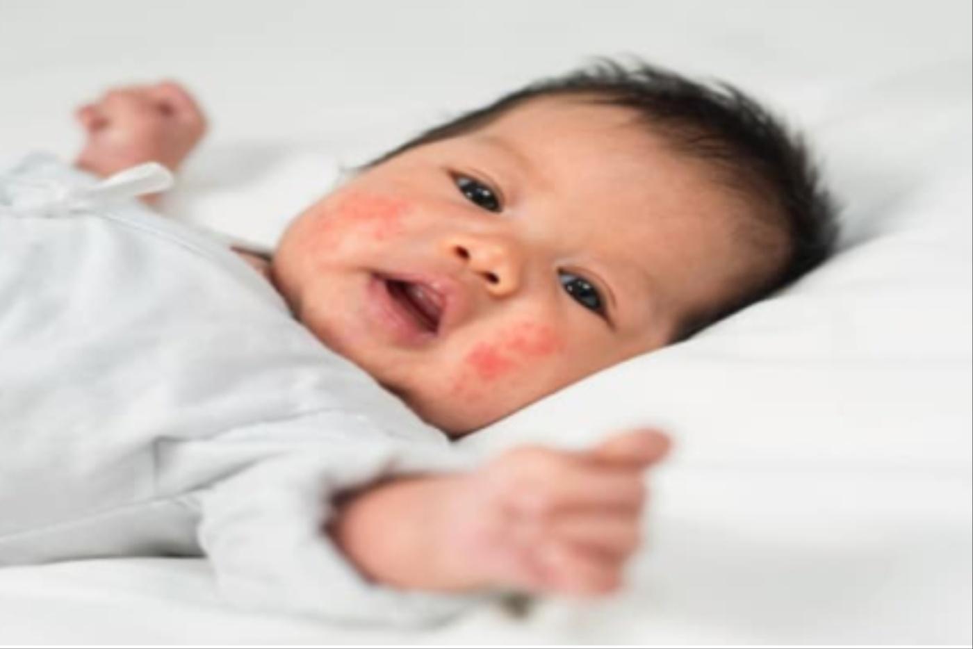 Cara Hilangkan Ruam Di Muka Bayi Dengan 7 Petua Semula Jadi