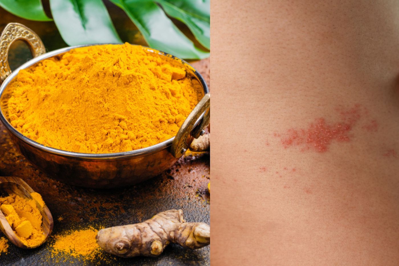 Ubat Kayap Cara Kampung, Pakai Serbuk Penaik Berkesan Rawat Kayap?