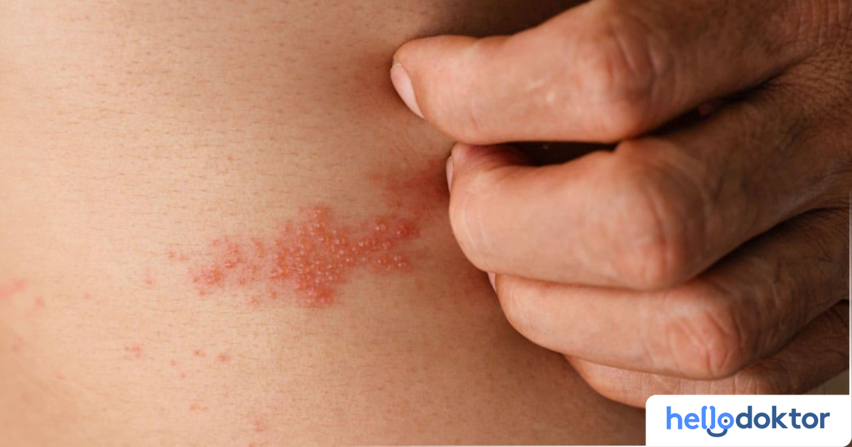 Ubat Kayap Cara Kampung, Pakai Serbuk Penaik Berkesan Rawat Kayap?