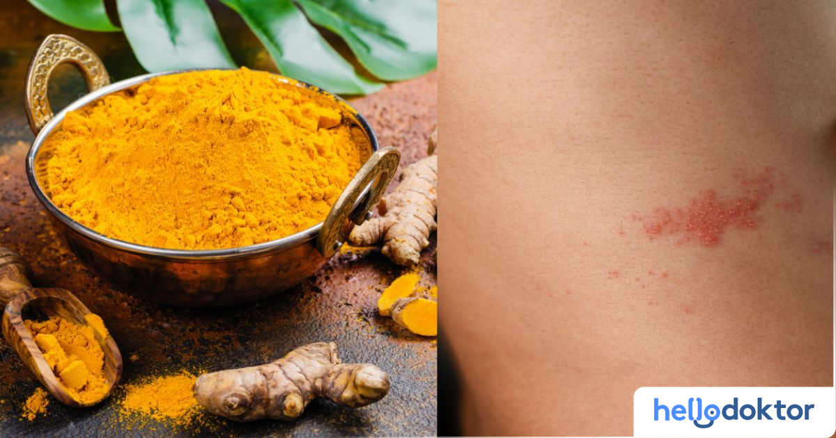 Ubat Kayap Cara Kampung, Pakai Serbuk Penaik Berkesan Rawat Kayap?