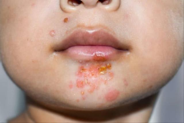 Kudis Api, Kondisi Kulit Impetigo Yang Biasa Menyerang Si Manja Anda!