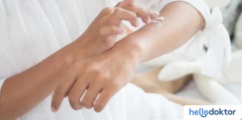 Ubat Eczema Paling Berkesan, Gabungan Ubat Moden & Tradisional!