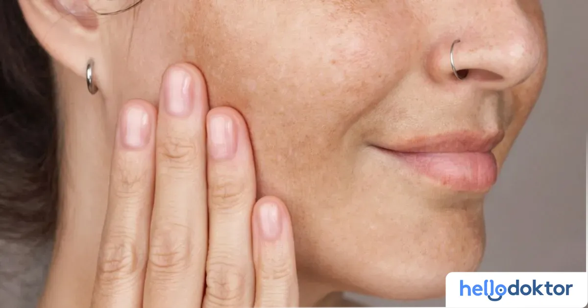 Jeragat Melasma Ada Ketika Hamil? Ini Apa Yang Anda Perlu Lakukan!